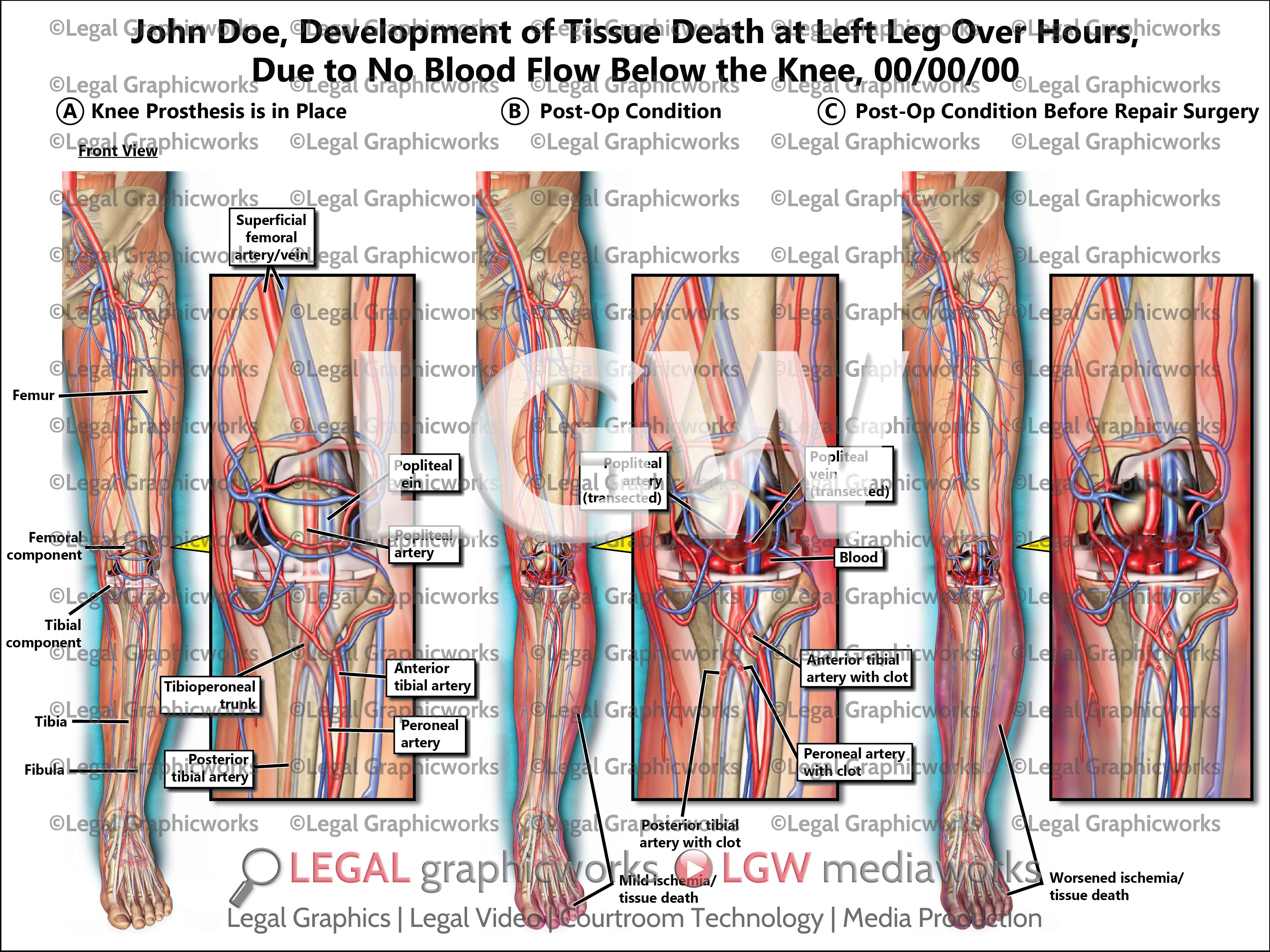 Development of Tissue Death at Left Leg Over Hours, Due to No Blood Fl ...