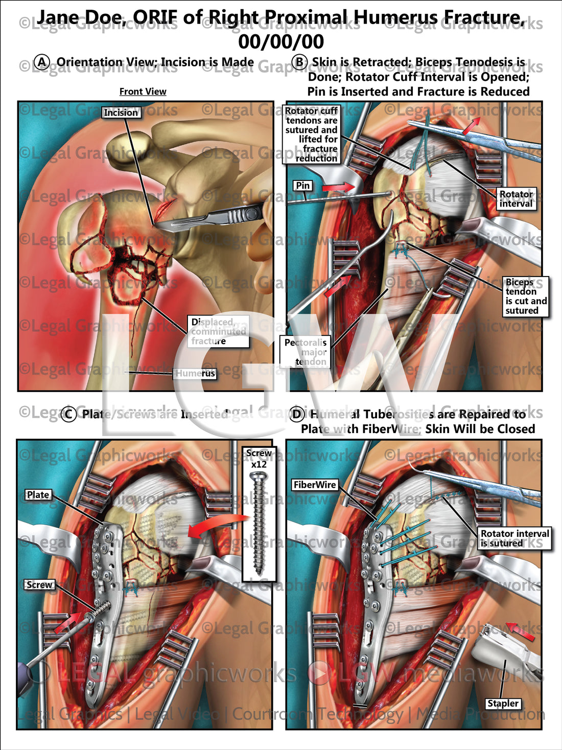 ORIF of Right Proximal Humerus Fracture – LGWgo