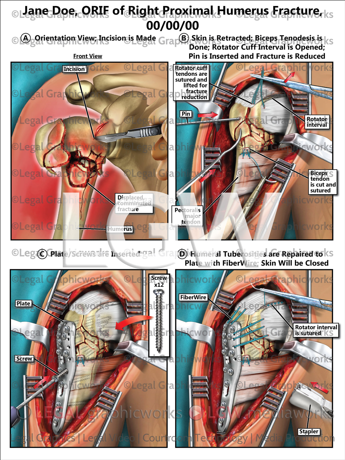 ORIF of Right Proximal Humerus Fracture – LGWgo