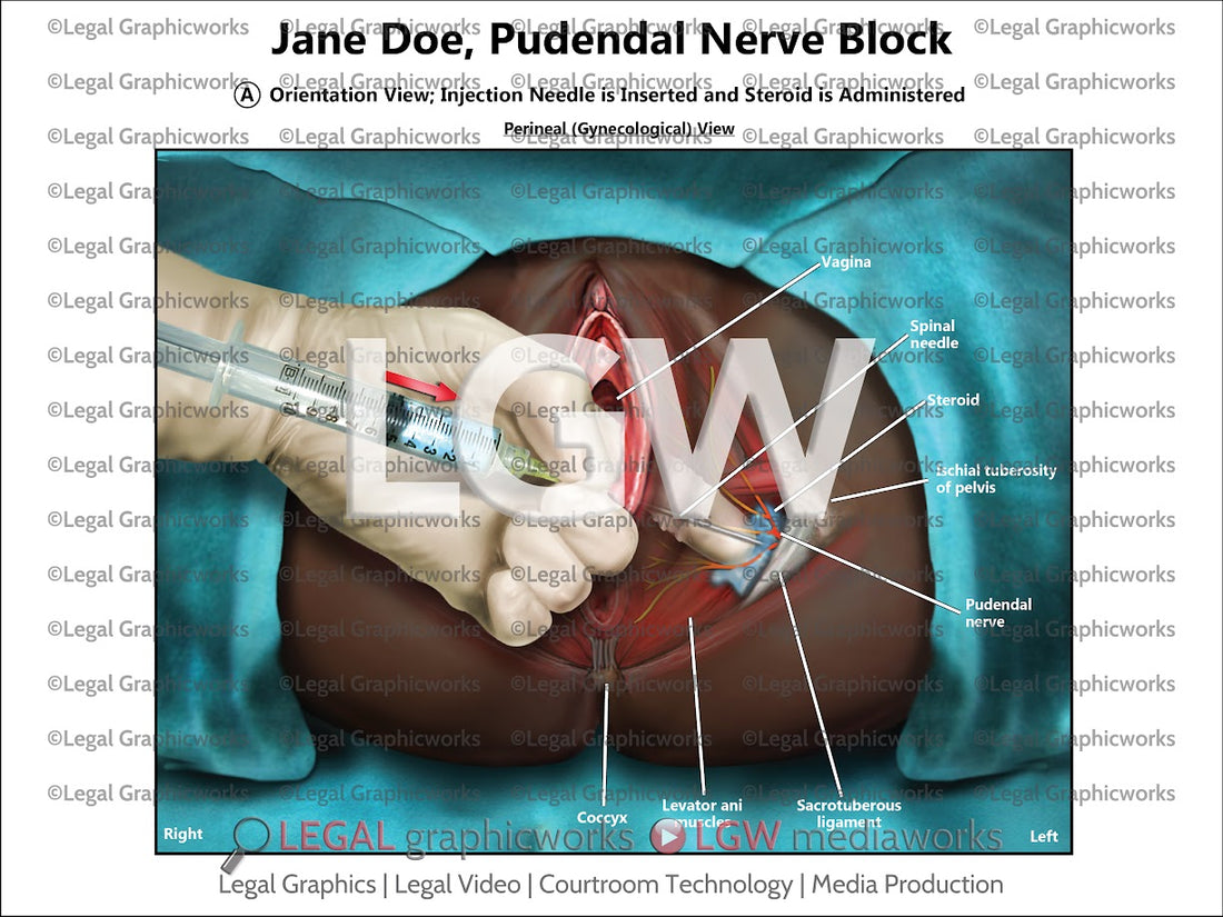 Pudendal Nerve Block – LGWgo