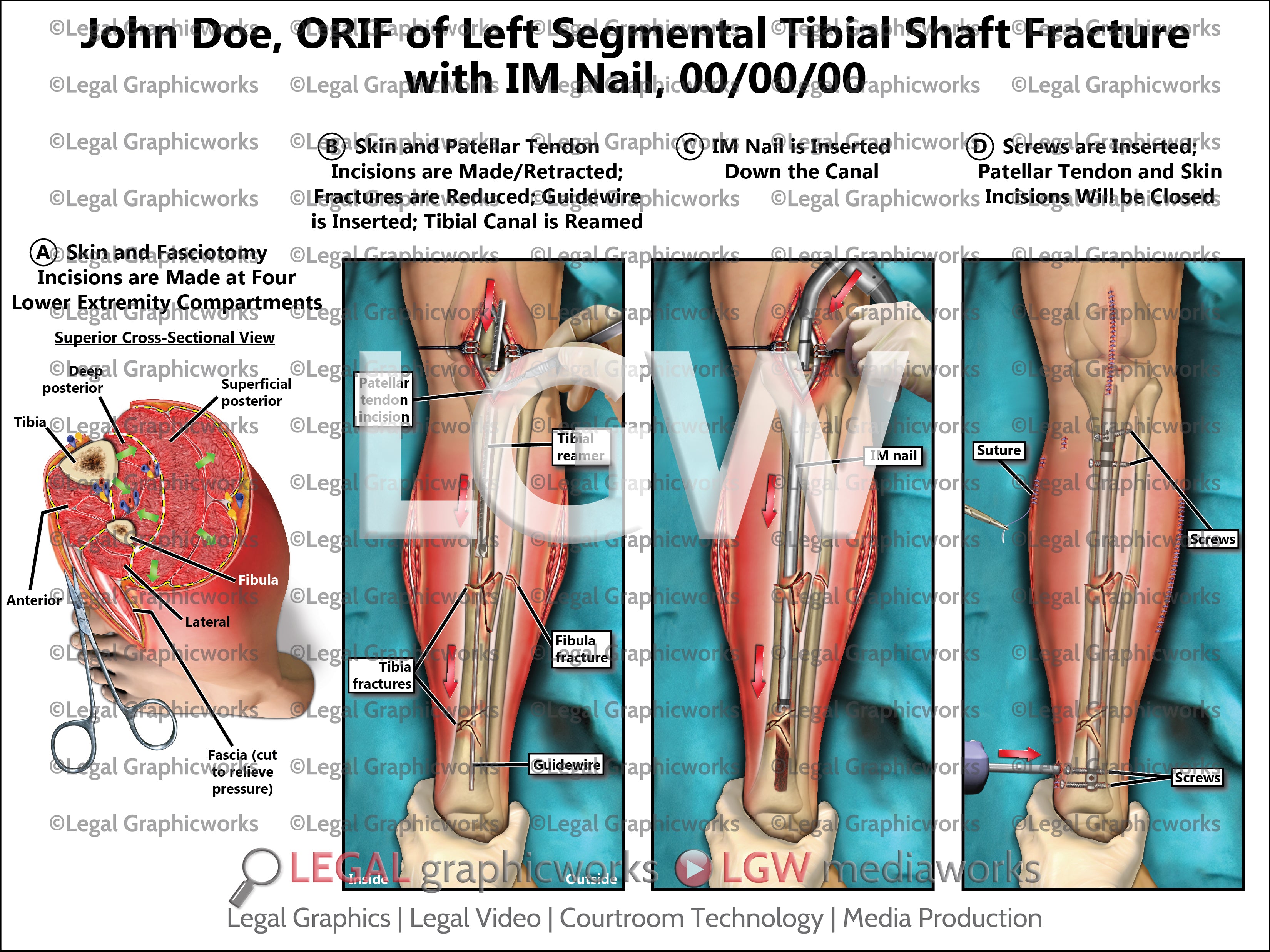 ORIF of Left Segmental Tibial Shaft Fracture – LGWgo