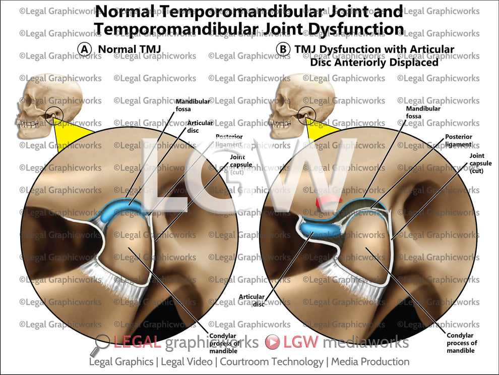 Normal Temporomandibular Joint and Temporomandibular Joint Dysfunction ...