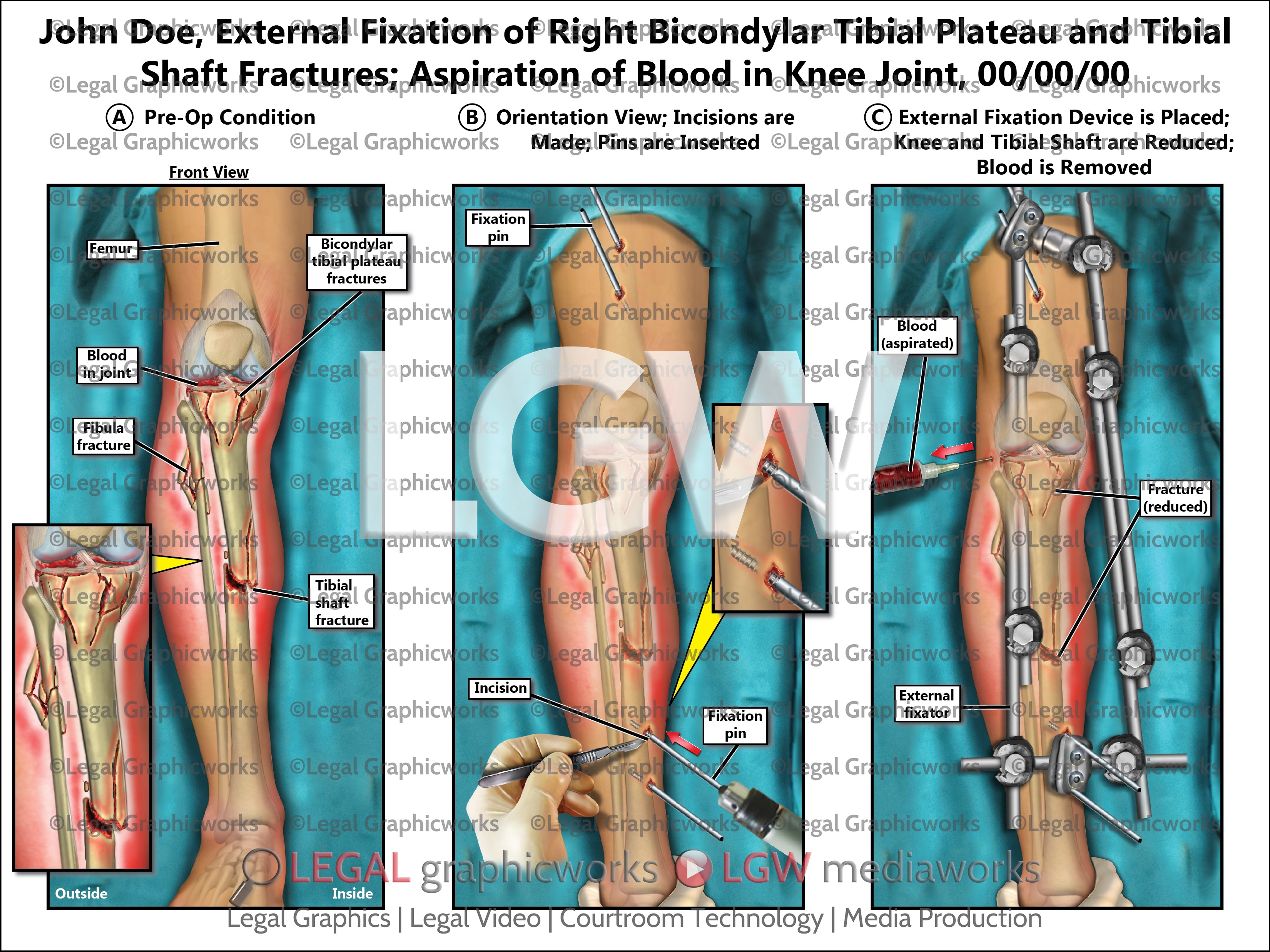 External Fixation of Right Bicondylar Tibial Plateau and Tibial Shaft ...