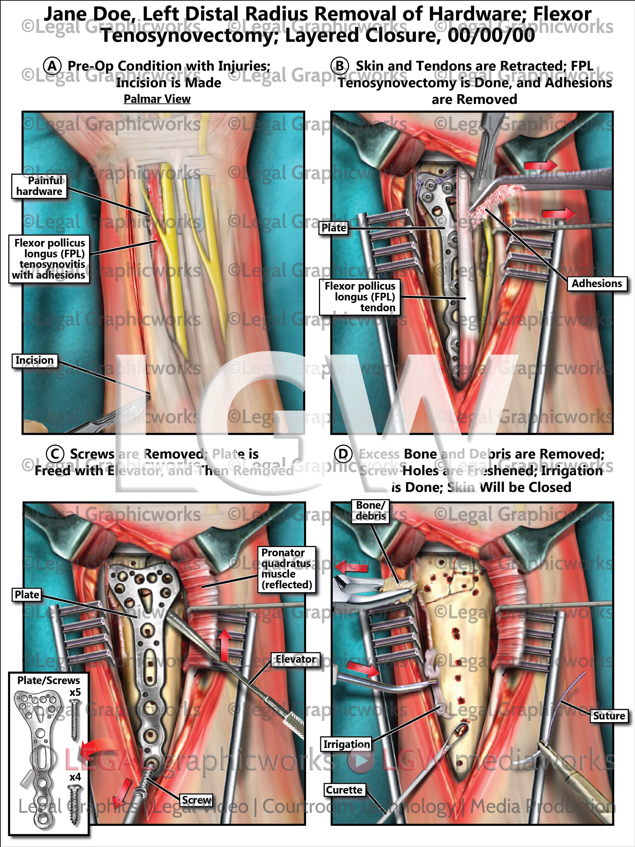 Left Distal Radius Removal of Hardware; Flexor Tenosynovectomy; Layere ...