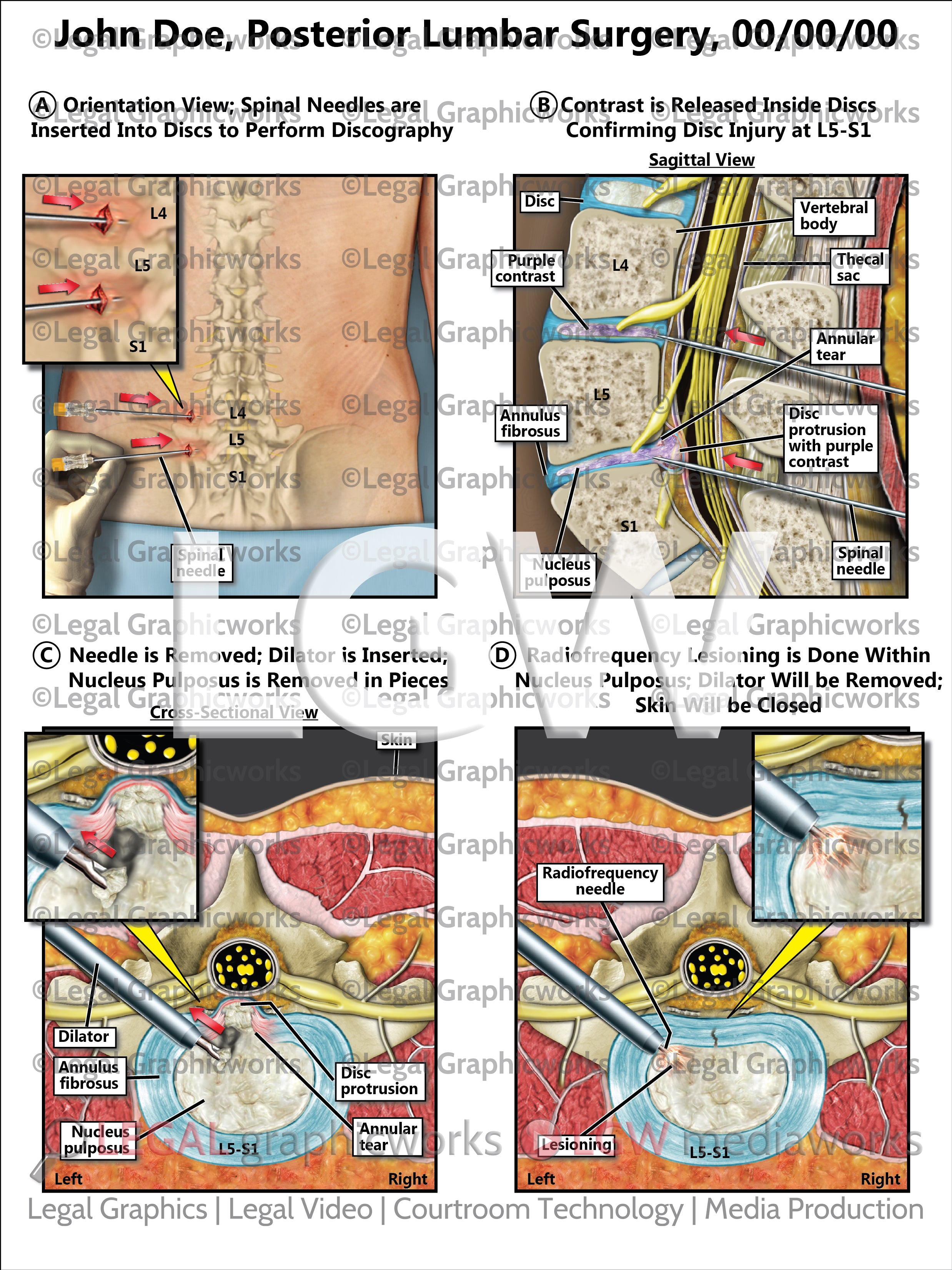 Posterior Lumbar Surgery – LGWgo
