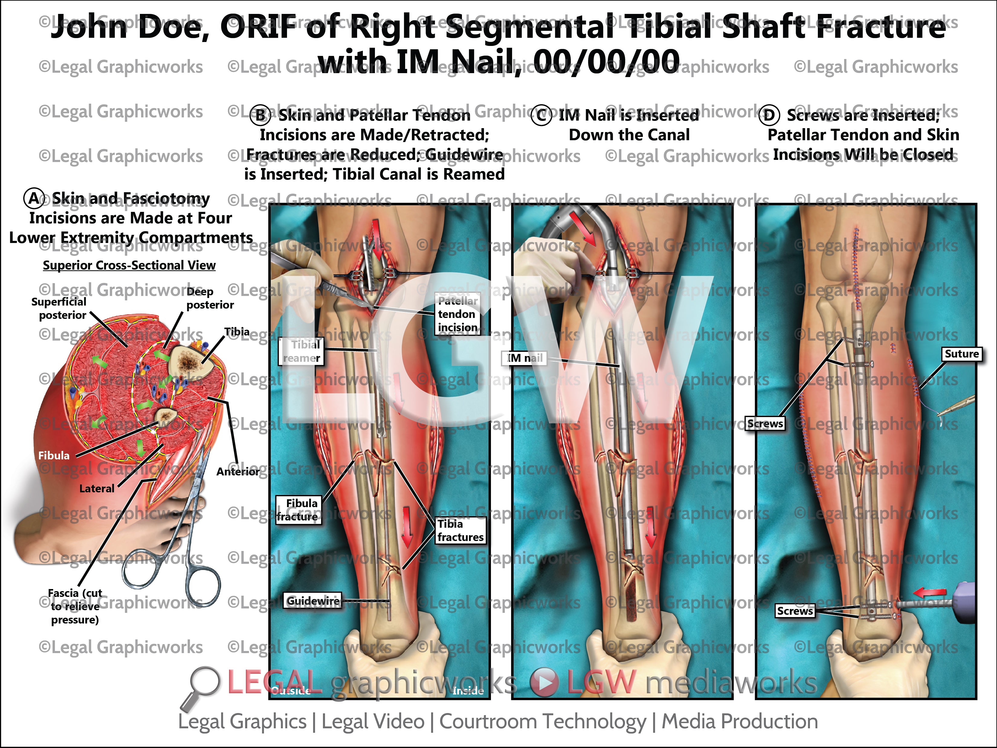 ORIF of Right Segmental Tibial Shaft Fracture with IM Nail – LGWgo