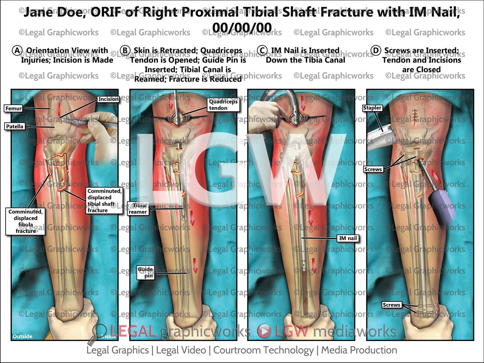 ORIF of Right Proximal Tibial Shaft Fracture with IM Nail – LGWgo